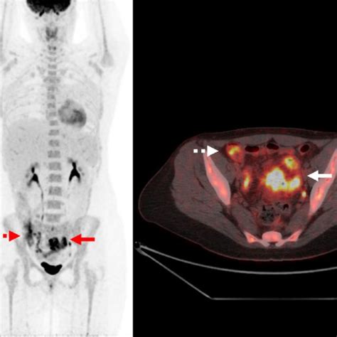 53 Year Old Male With Sarcoma And Two Fdg Avid Metastatic Lesions Download Scientific Diagram