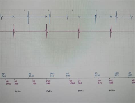 Remote Download Of Dual Chamber Pacemaker R Ecg