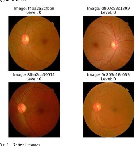 Figure 1 From A Deep Learning Model For Diagnosing Diabetic Retinopathy Using Efficientnet B0