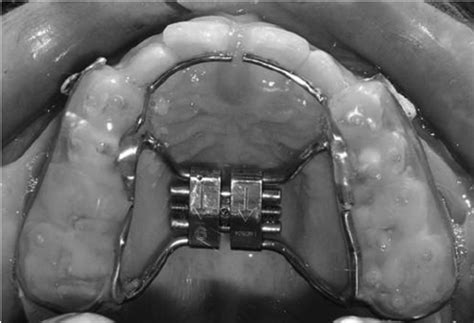 The Acrylic Cap Splint Type Rapid Palatal Expander Used For Patients In