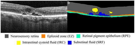 Automatic Segmentation Of Retinal Fluid And Photoreceptor Layer From Optical Coherence