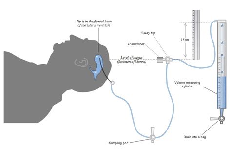 Methods Of Intracranial Pressure Monitoring Deranged Physiology