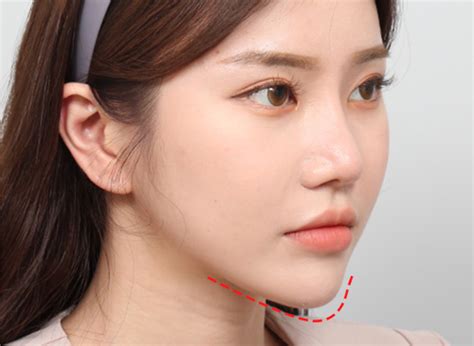 Square Jaw Reduction Surgery Ab Plastic Surgery