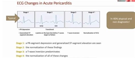 The Heart 🔴ecg Feature Of Acute Pericarditis Stage 1