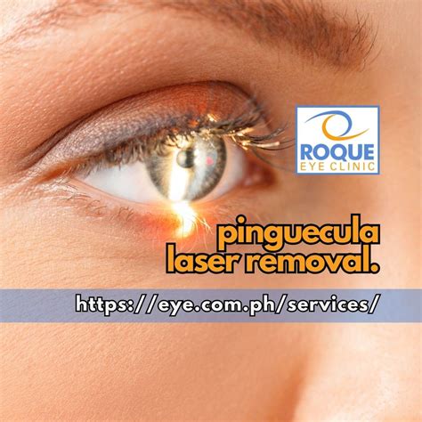 Argon Yag Laser Peripheral Iridotomy One Eye Pf Only Roque Eye