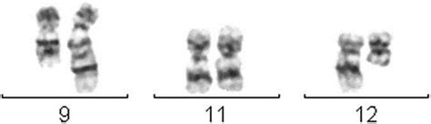 Metaphase Chromosomes Involved In Translocation Is Partially Pictured
