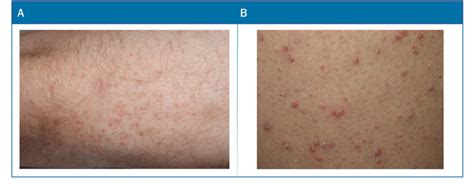 Folliculitis In Two Tapinarof Treated Patients In Psoaring 1 And 2 A Download Scientific