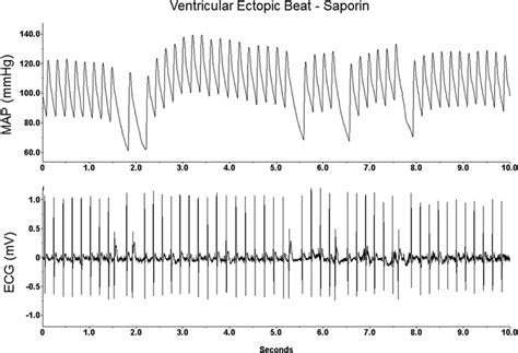 Representative Ecg Top Trace Demonstration Of Ventricular Ectopic