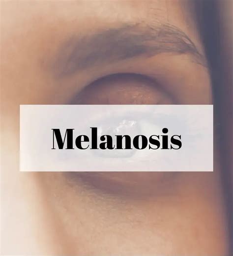 Melanosis Types Causes And Management