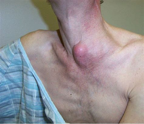 Left Supraclavicular Abscessed Lymph Node Translational Medicine