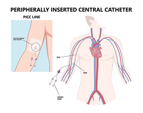 How To Exercise With A Picc Line