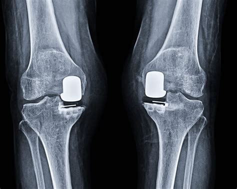 Partial Knee Replacement Adam Sassoon Md Ms