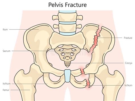 Pelvis Diagram Stock Illustrations 630 Pelvis Diagram Stock