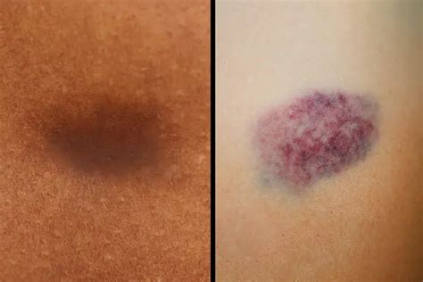 Bruises Symptoms Causes Diagnosis Treatment Remedies Prevention