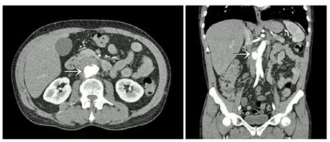 Mycotic Aortic Aneurysm