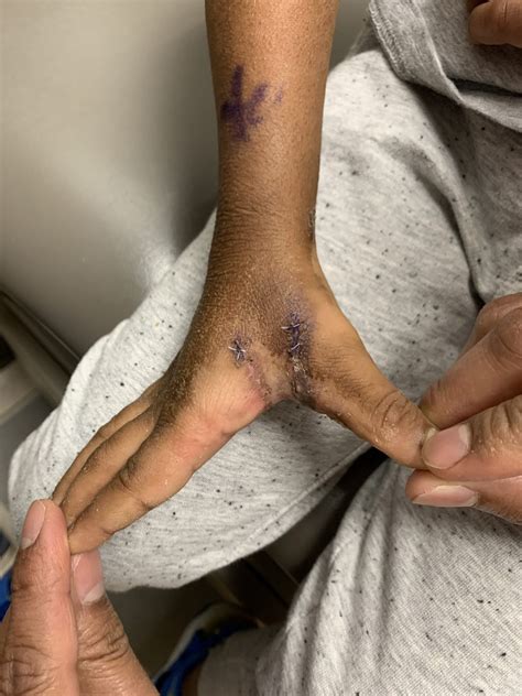 Tight First Webspace Congenital Hand And Arm Differences Washington