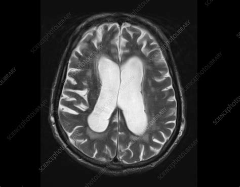 Frontotemporal Dementia Mri And Ct Scans Stock Image C0585173