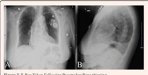 Acute Pericardial Effusion From Pacemaker Lead Perforation Of Right
