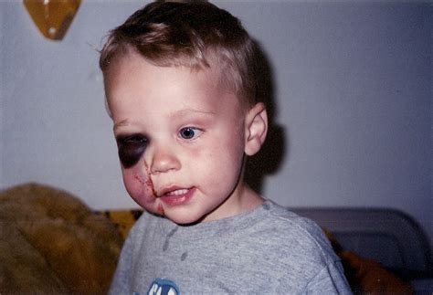 Swollen Eye Socket From Punch At Juliane Michaelis Blog