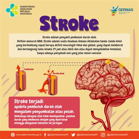 Stroke Menurut Kemkes Pengertian Arti Definisi Dari