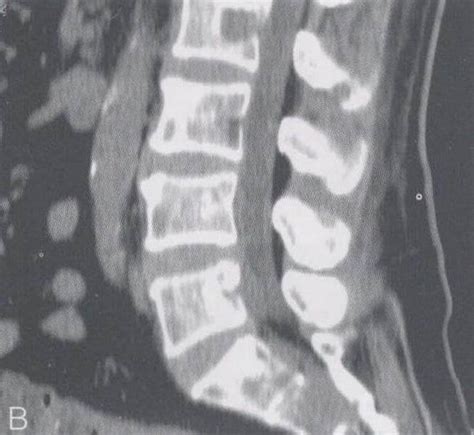 多发性骨转移瘤2 肿瘤学 医学
