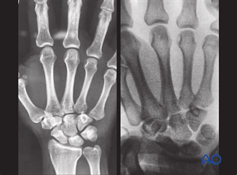 Dislocation And Fracture Dislocation Of The Carpometacarpal Joints