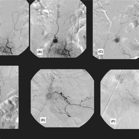 Preoperative Mri Images Show A Round‐shaped Intradural Lesions Download Scientific Diagram