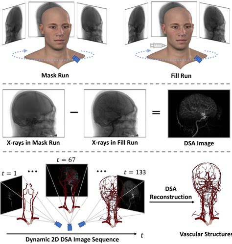 [论文审查] 3d vessel reconstruction from sparse view dynamic dsa images via