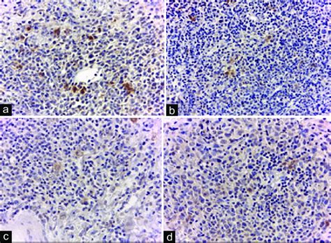 Positive Cd30 Expression Using A Cutoff Value Of 0 A Non Germinal