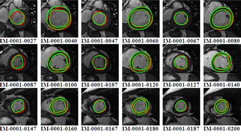Figure 9 From Automatic Segmentation Of The Left Ventricle From Cardiac