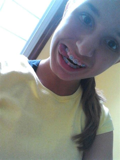 Pin On Braces