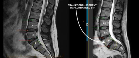 “lumbarised S1” The Transitional Potentially Mobile Lumbosacral