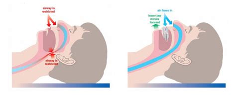 Why Sleep Apnea Mouthpiece Is Better Than Cpap Machine