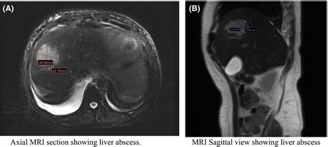 A Axial Mri Section Showing Liver Abscess B Mri Sagittal View Download Scientific Diagram