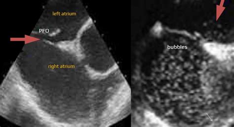 Cryptogenic Stroke What Physicians Must Know Cme India