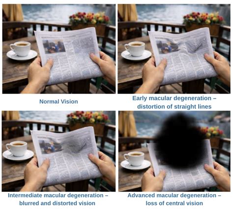 Early Macular Degeneration First Signs And Symptoms Eye And Laser