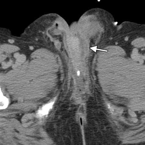 Imaging Findings In Transgender Patients After Gender Affirming