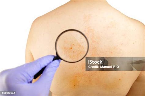 Control De Psoriasis En La Espalda De Un Hombre Foto De Stock Y Más