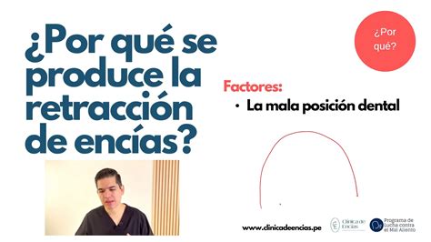 5 Causas Y Tratamientos De La Retracción De Encías Todo Lo Que Debes Saber