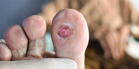 The Emerging Role Of Regenerative Treatments In Diabetic Wound Care