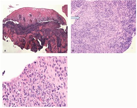 Polyps And Tumors Of The Esophagus Basicmedical Key