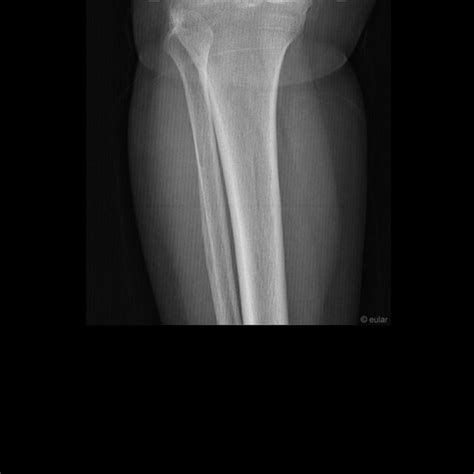 X Ray Of The Wrist Calcifications Of The Tfcc Asterisks By Cppd