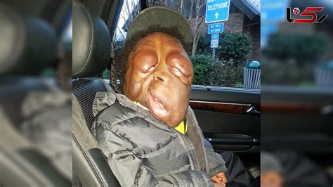 ببینید چگونه بیماری این پسر بچه چهره او را وحشتناک و شبیه موجودات فضایی کرده است عکس