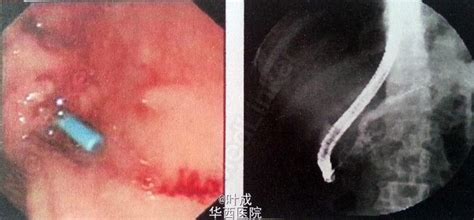 慢性胰腺炎收治一例 医联