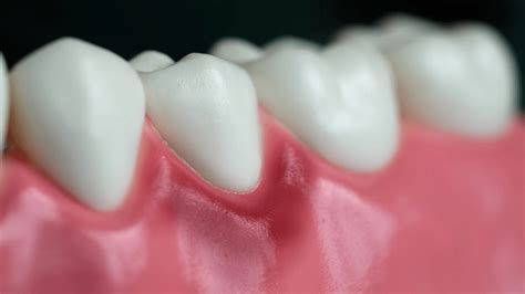 Gingivitis Causes And Prevention