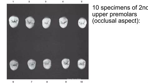 2nd Upper Premolar Anatomy Pptx 2nd Upper Premolar Anatomy Pptx