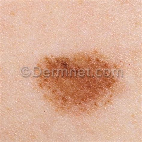 Skin Cancer Classification Image Data Kaggle Skin Cancer Classification Image Data Kaggle