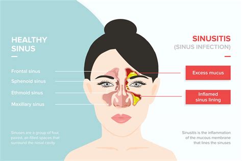 Sinus Infection Brain Symptoms