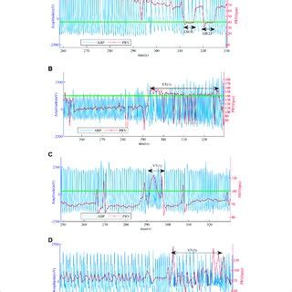 ABP And PRV Signals Of Patients A ABP And PRV Signals Of A Patient Download Scientific
