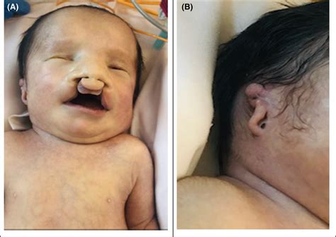 A B Bilateral Microphthalmia Bilateral Cleft Lip And Palate And
